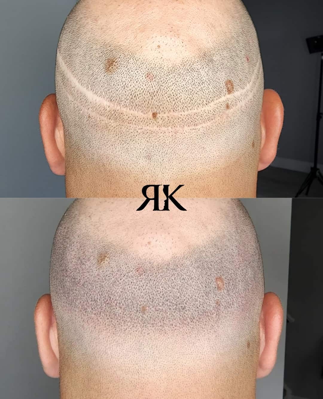 Scar Camouflage | Ryan Kingsbury | Scalp Micropigmentation